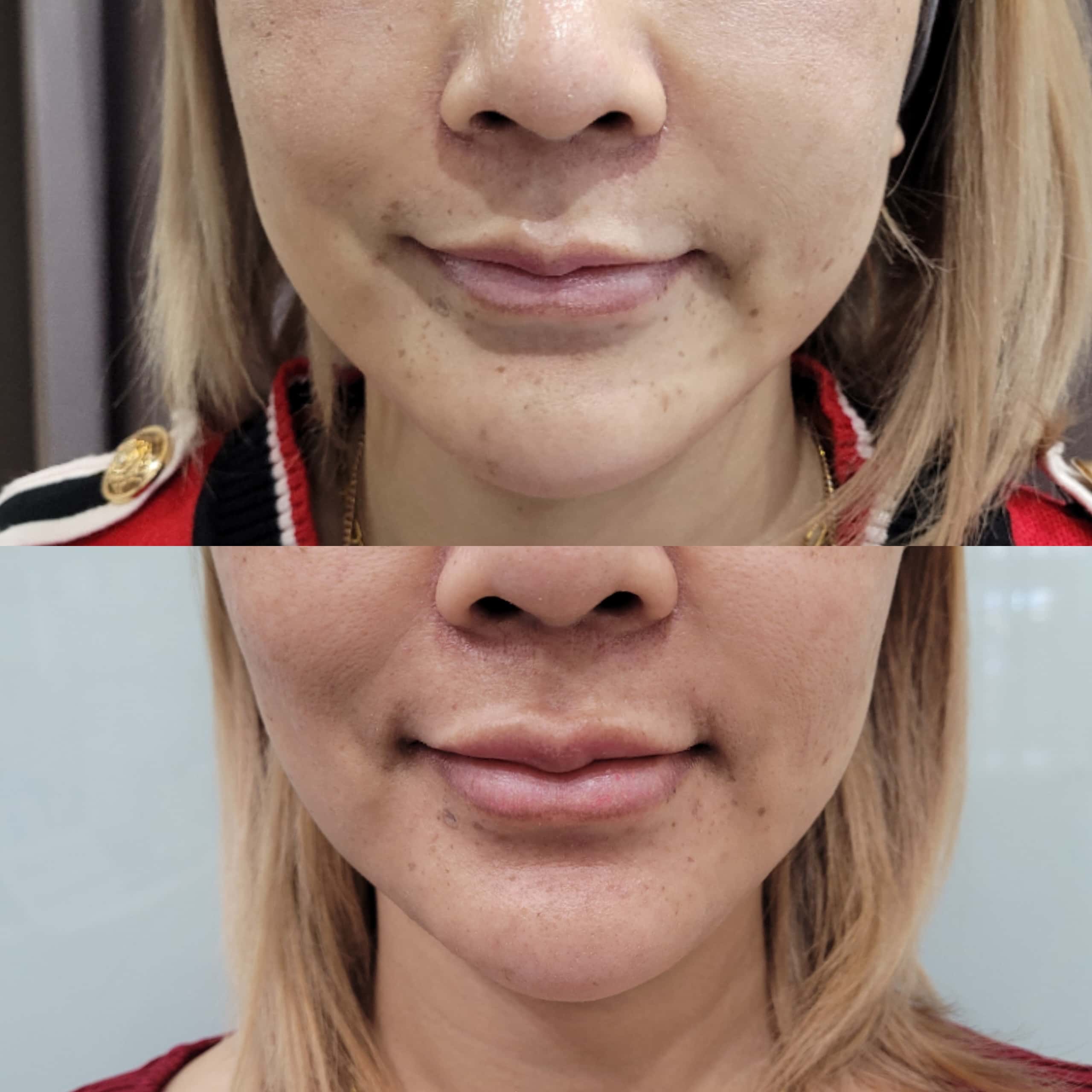 Vaginal Fillers - Siam Clinic Thailand