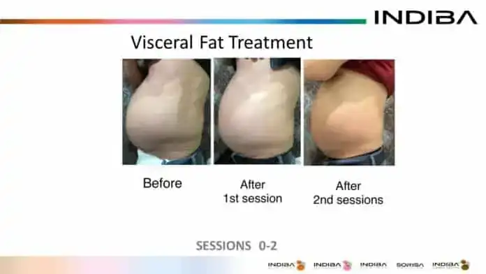 INDIBA Deep Care: The Ultimate Skin & Body Rejuvenation