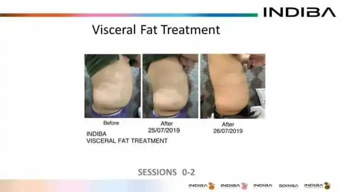 INDIBA Deep Care: The Ultimate Skin & Body Rejuvenation