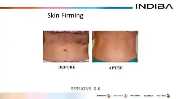 INDIBA Deep Care: The Ultimate Skin & Body Rejuvenation