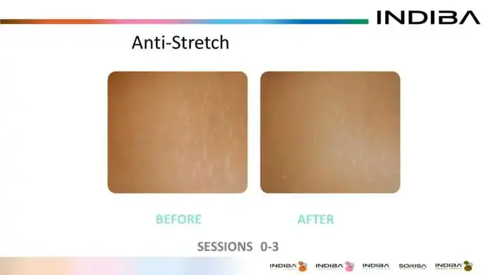 INDIBA Deep Care: The Ultimate Skin & Body Rejuvenation