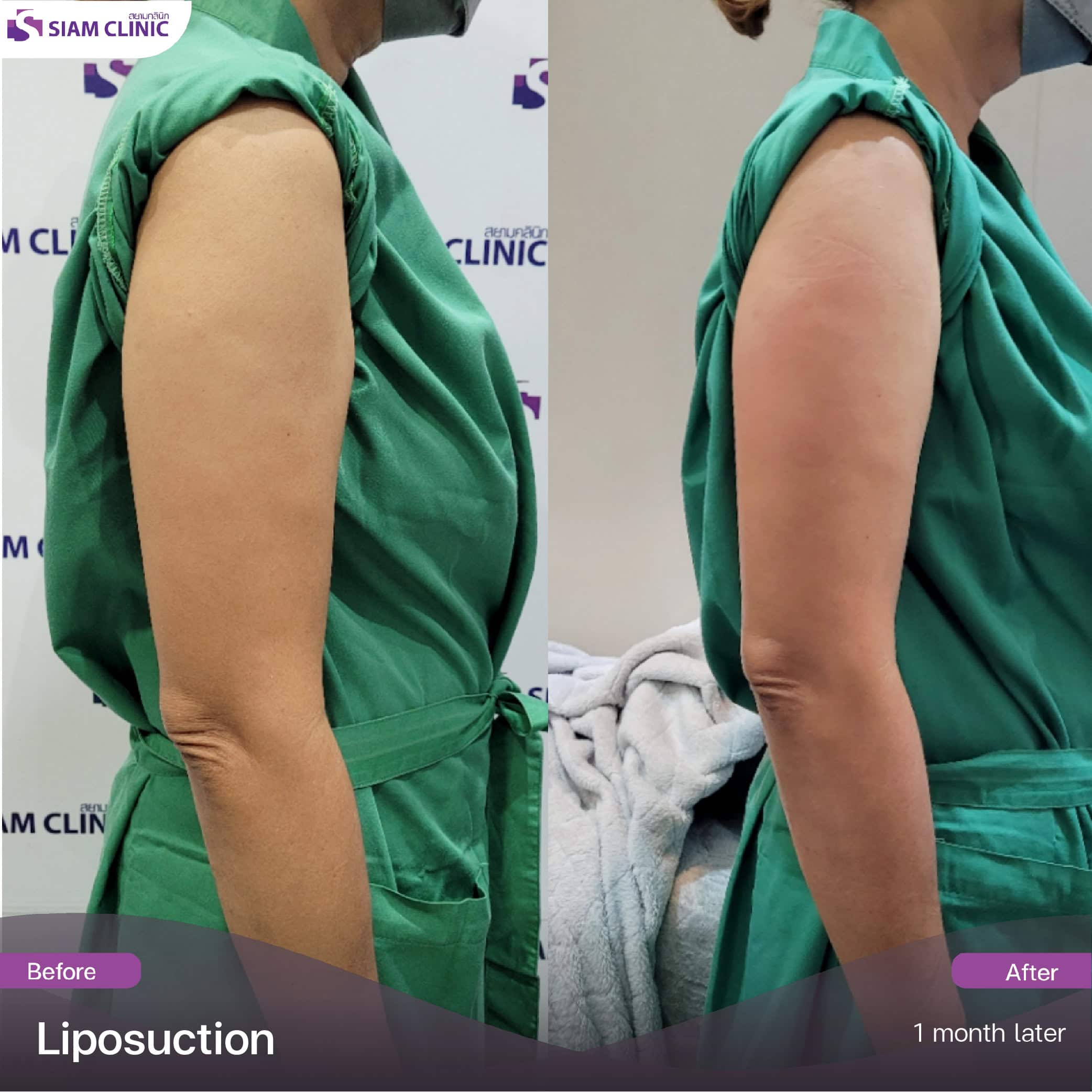 Liposuction Before and After Photos - Siam Clinic Thailand
