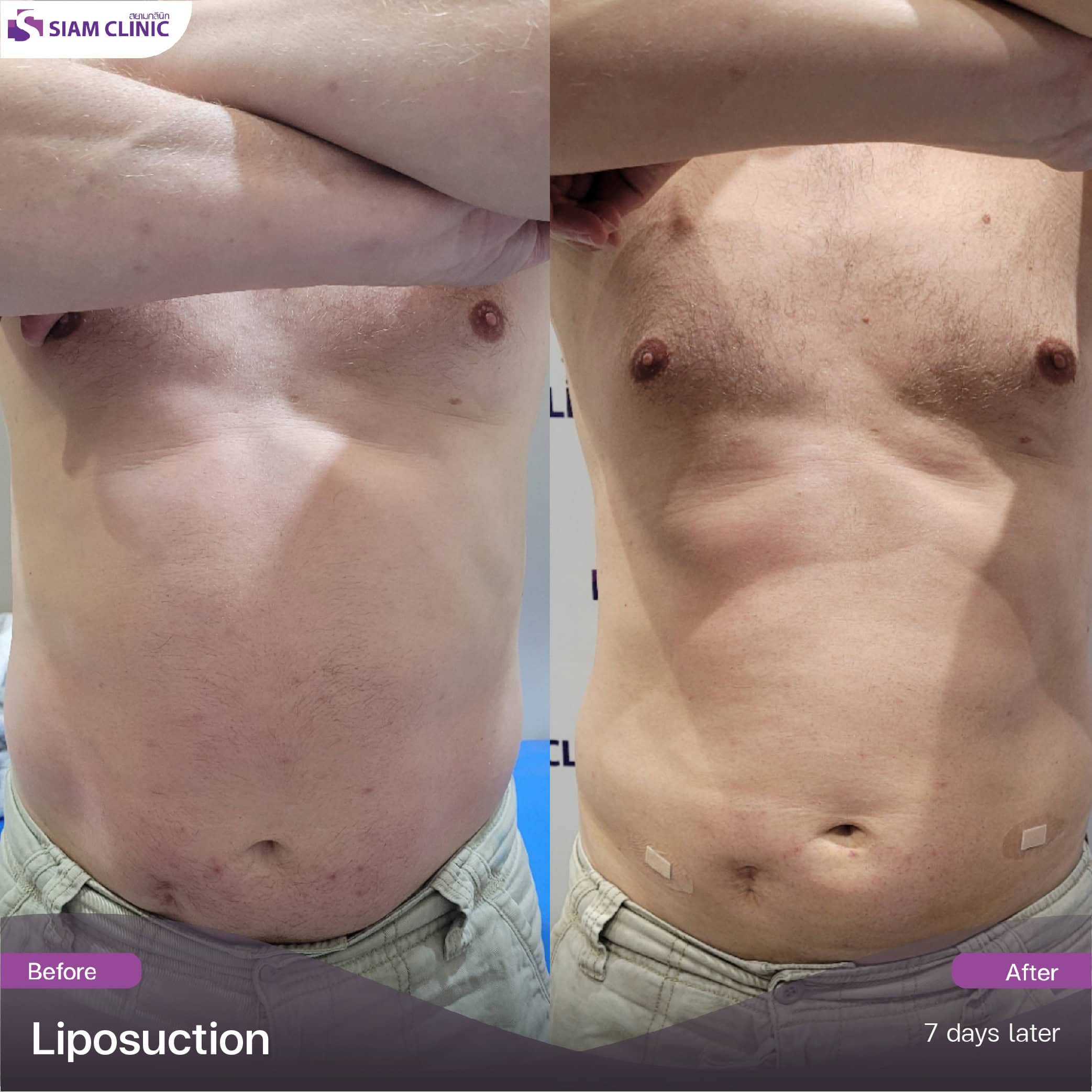 รีวิว ดูดไขมัน (Liposuction Reviews) - Siam Clinic Thailand