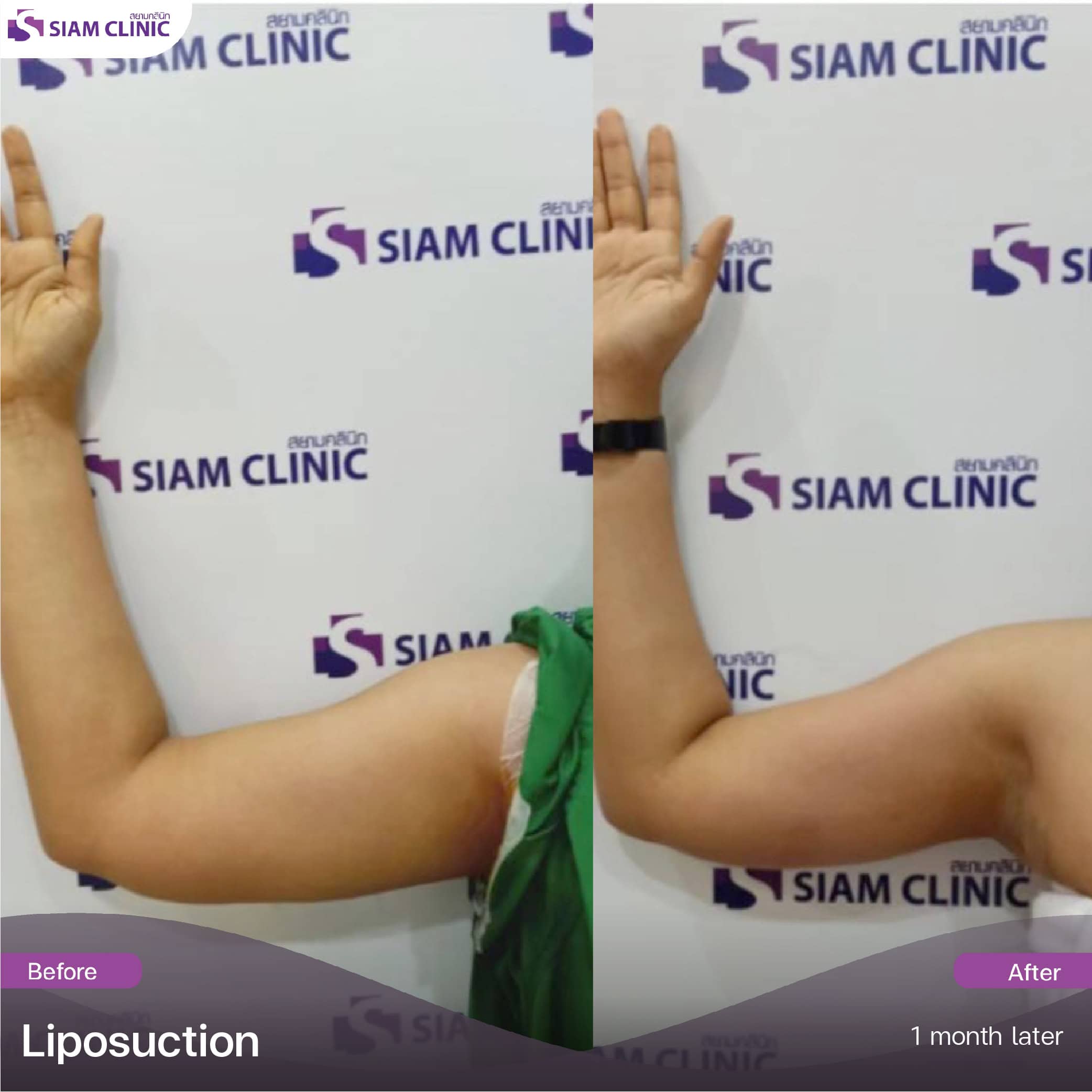 Liposuction Before and After Photos - Siam Clinic Thailand