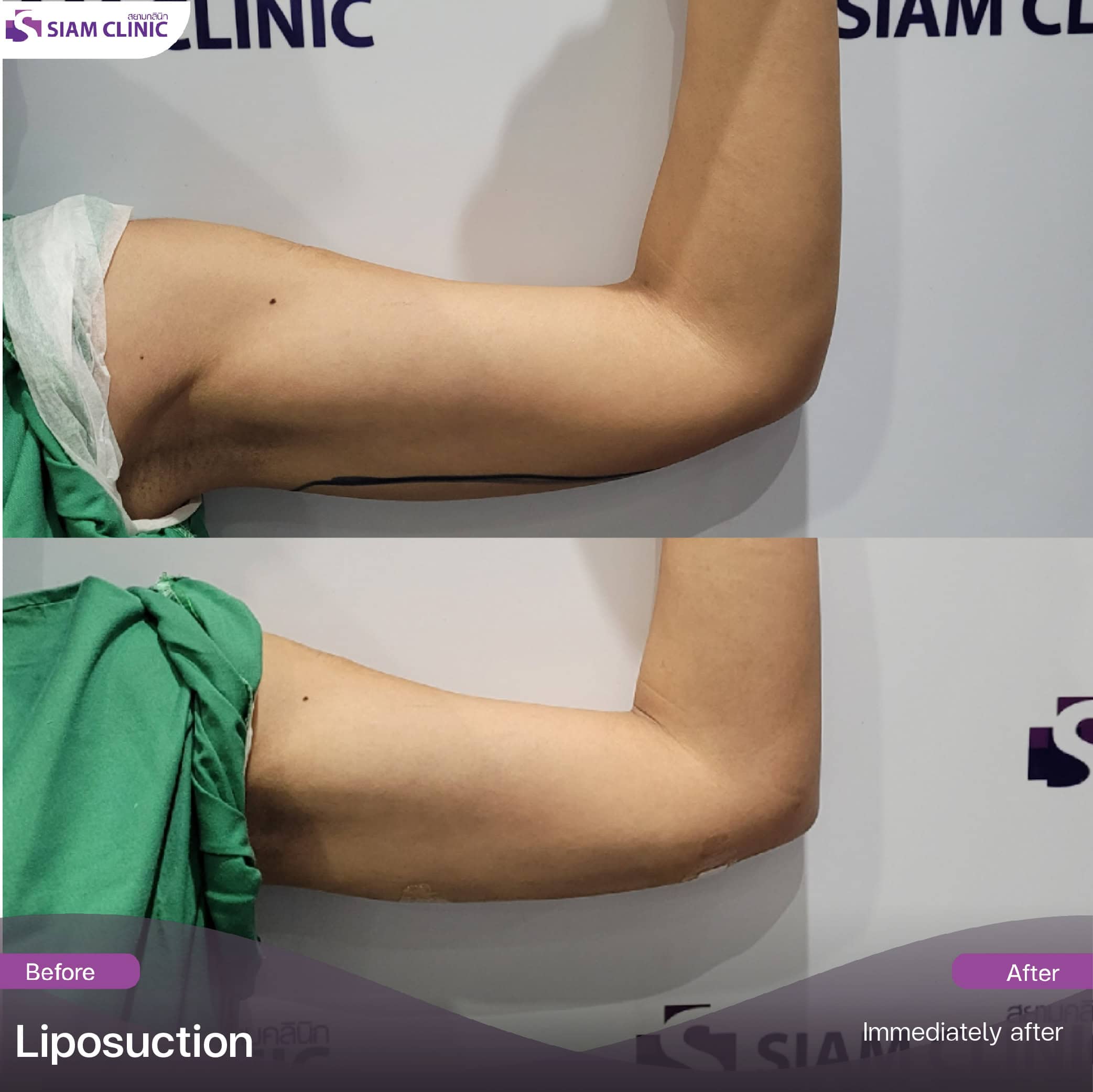 รีวิว ดูดไขมัน (Liposuction Reviews) - Siam Clinic Thailand