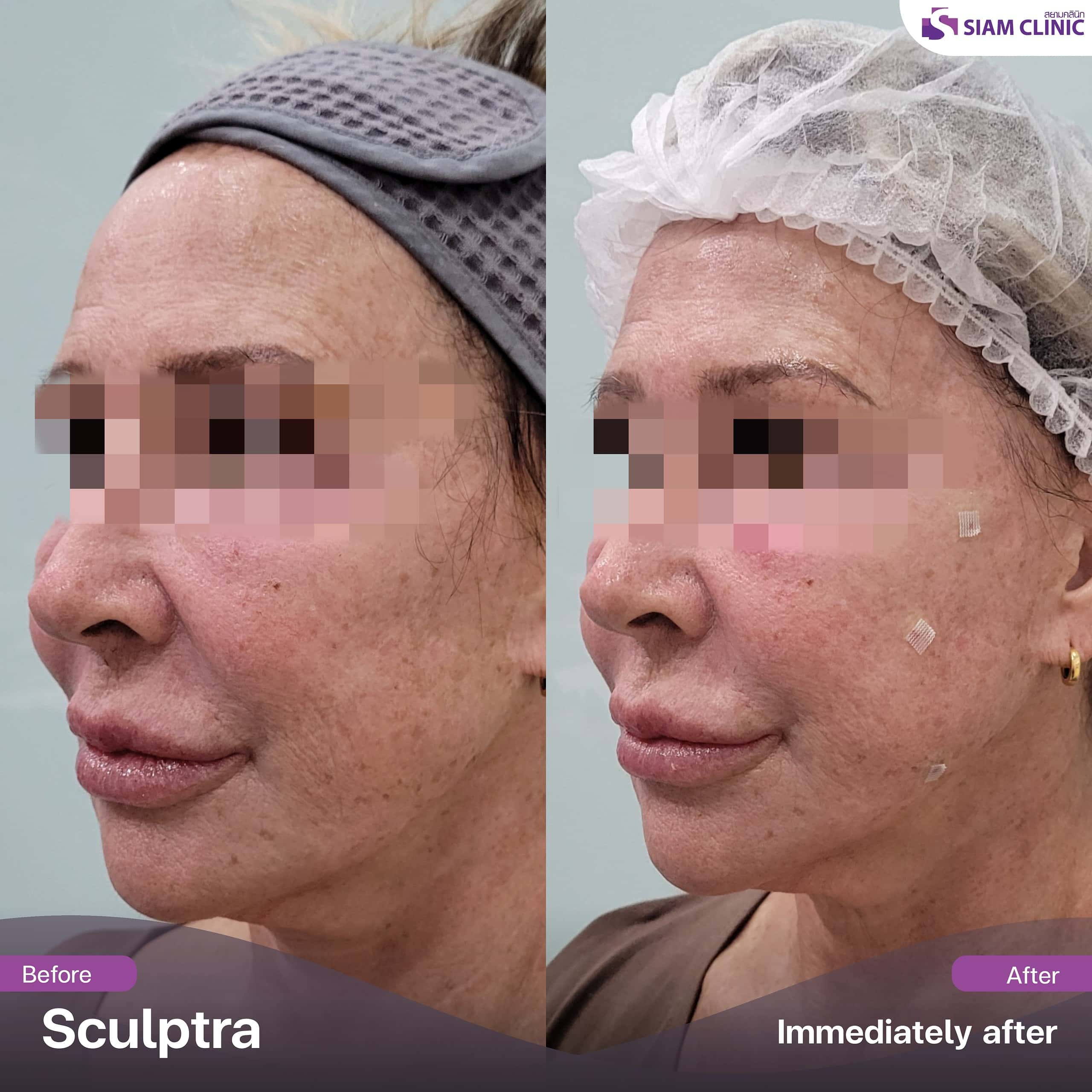 รีวิว Sculptra (Sculptra Reviews) - Siam Clinic Thailand